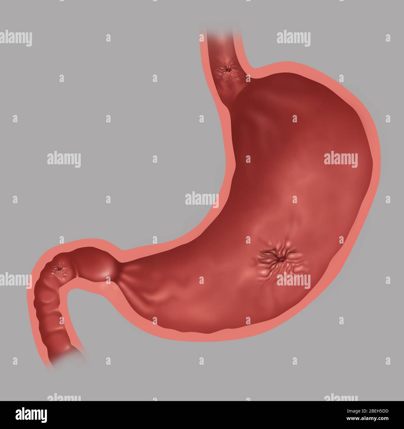 Gastrointestinal ulcers hi-res stock photography and images - Alamy