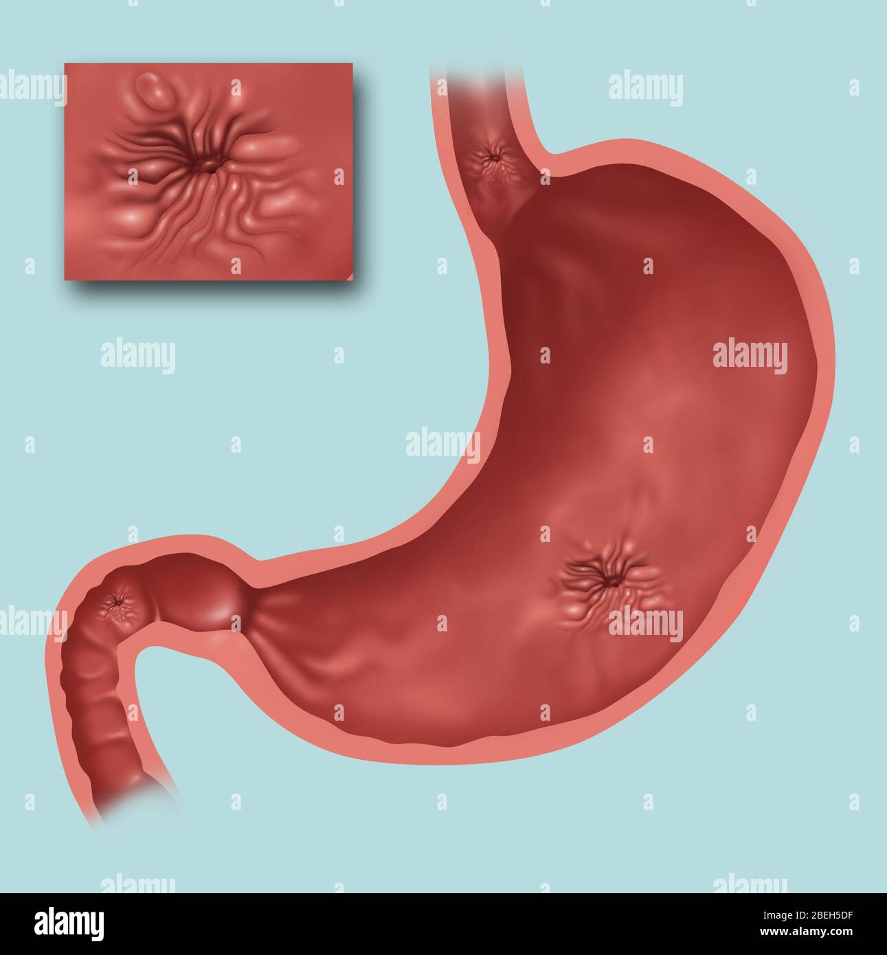 Stomach Ulcers, Illustration Stock Photo - Alamy