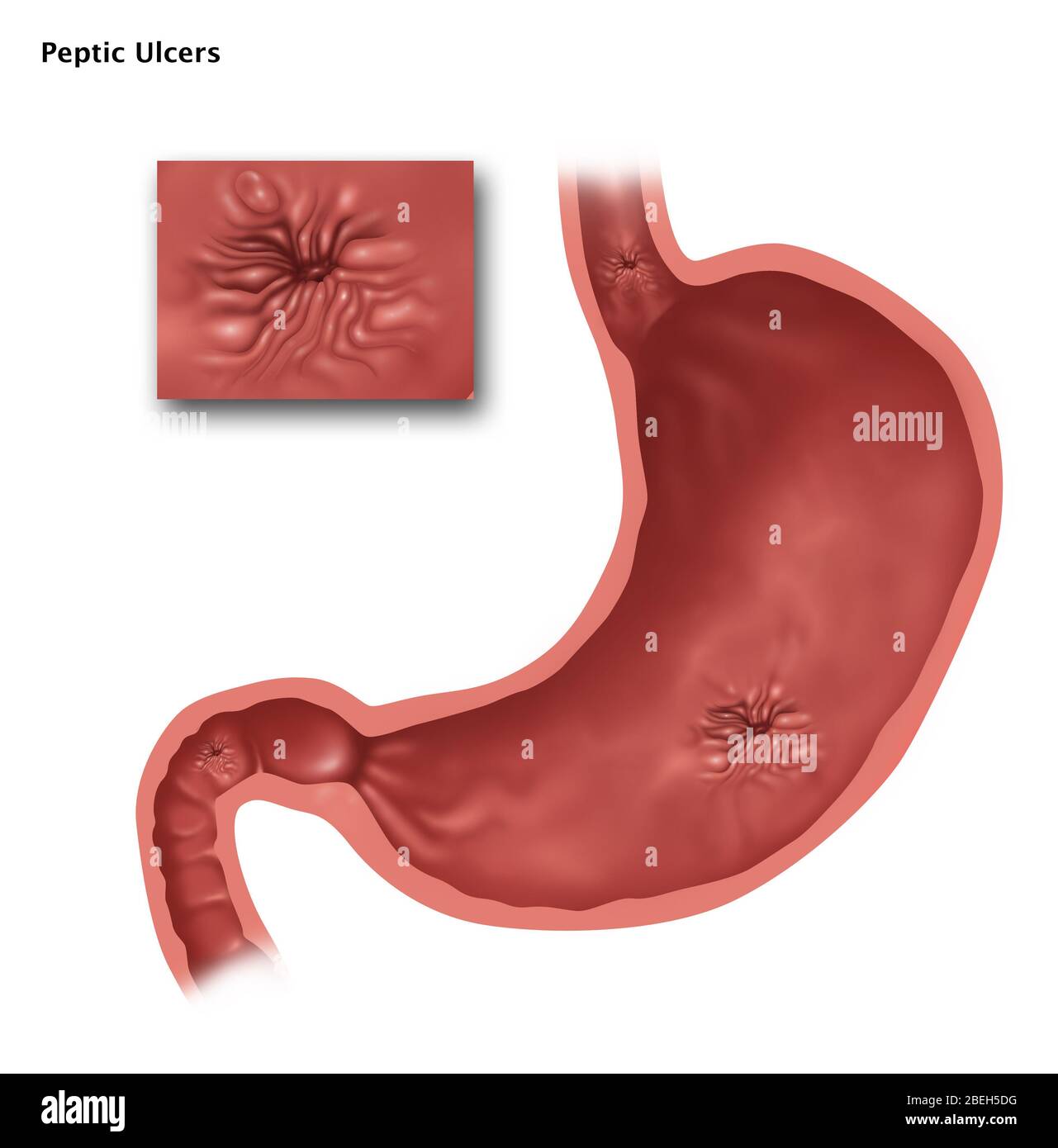 Stomach Ulcers, Illustration Stock Photo - Alamy