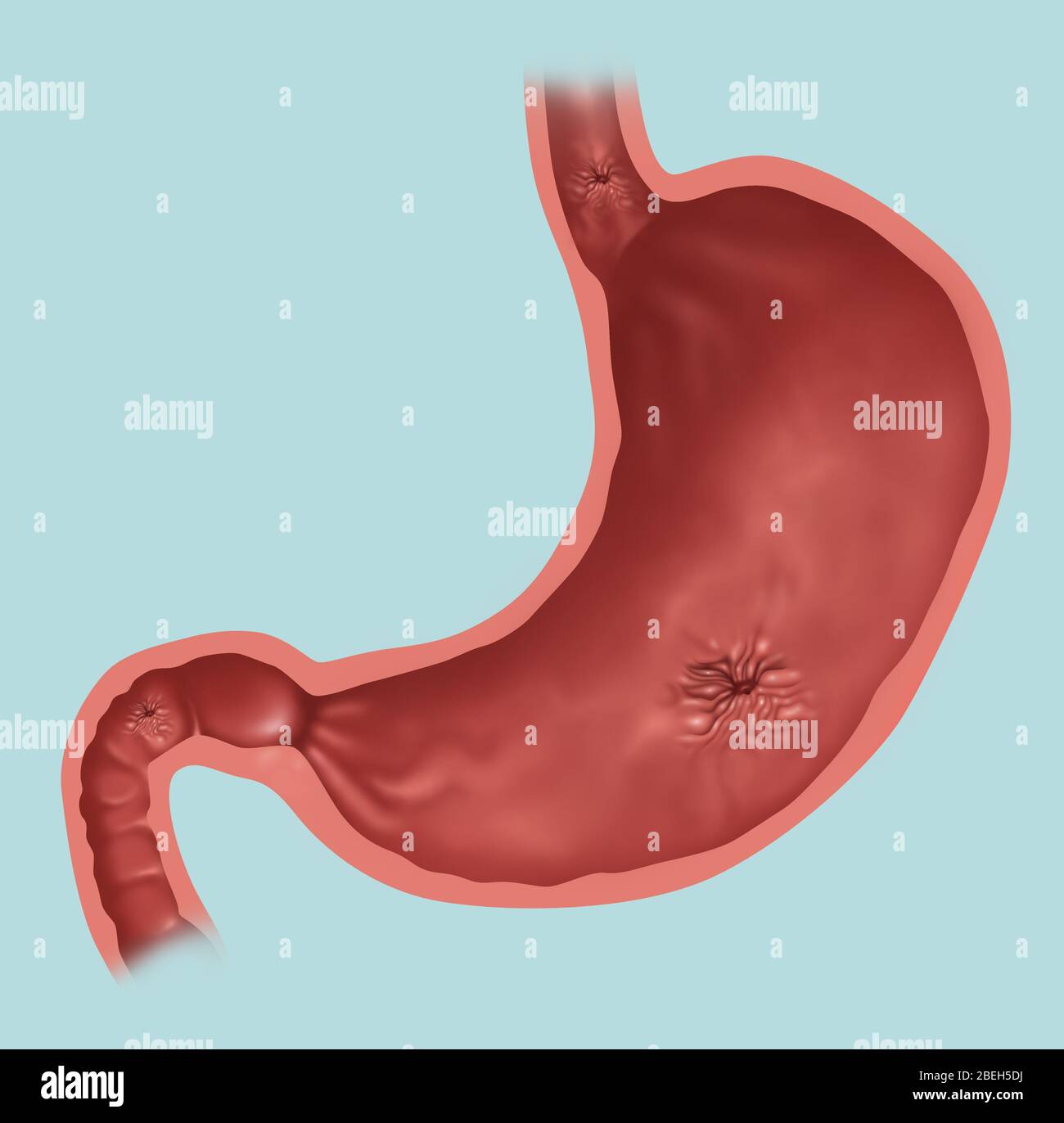 Stomach Ulcers, Illustration Stock Photo - Alamy