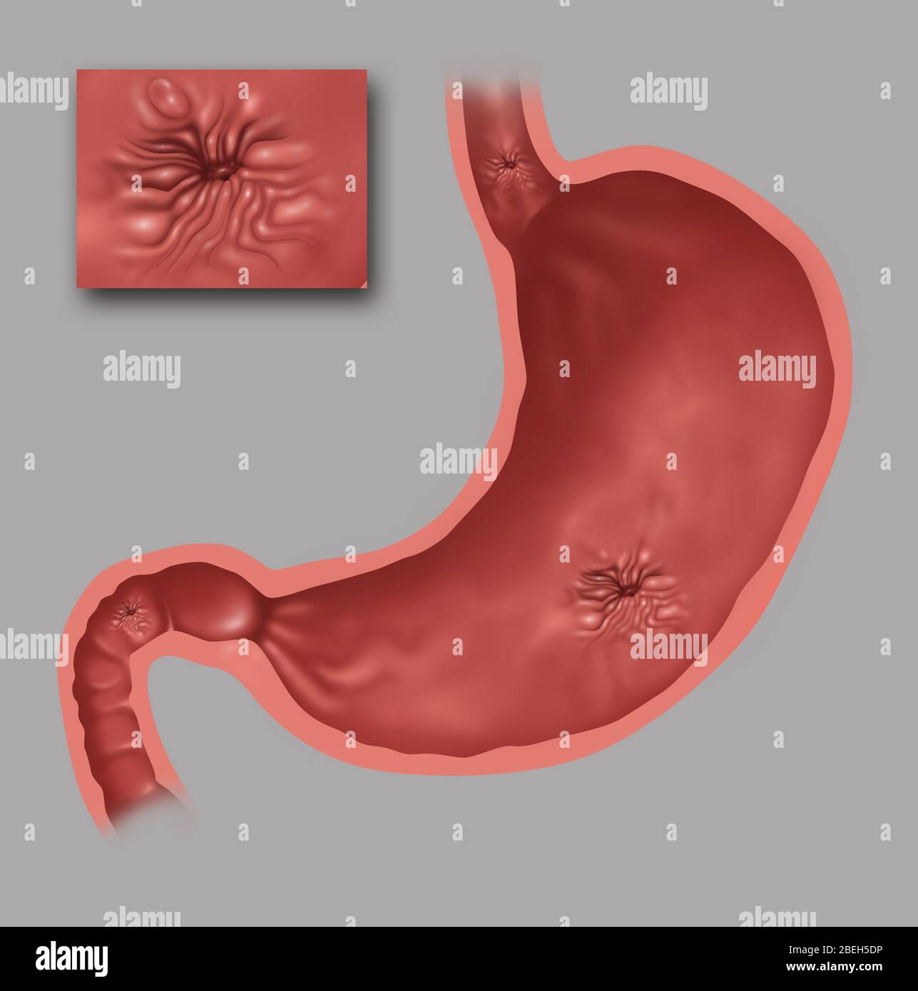 Gastric ulcers hi-res stock photography and images - Alamy