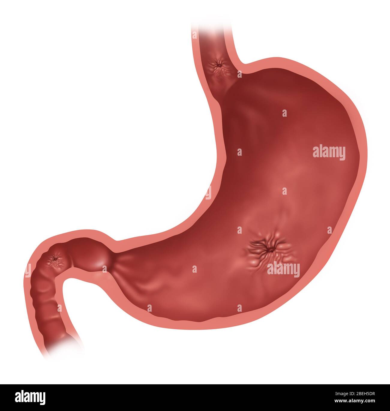 Gastric ulcers hi-res stock photography and images - Alamy