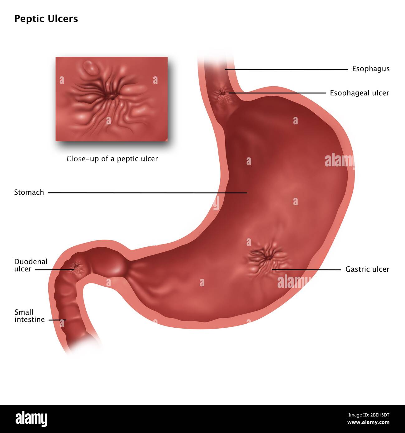 Stomach Ulcers, Illustration Stock Photo - Alamy