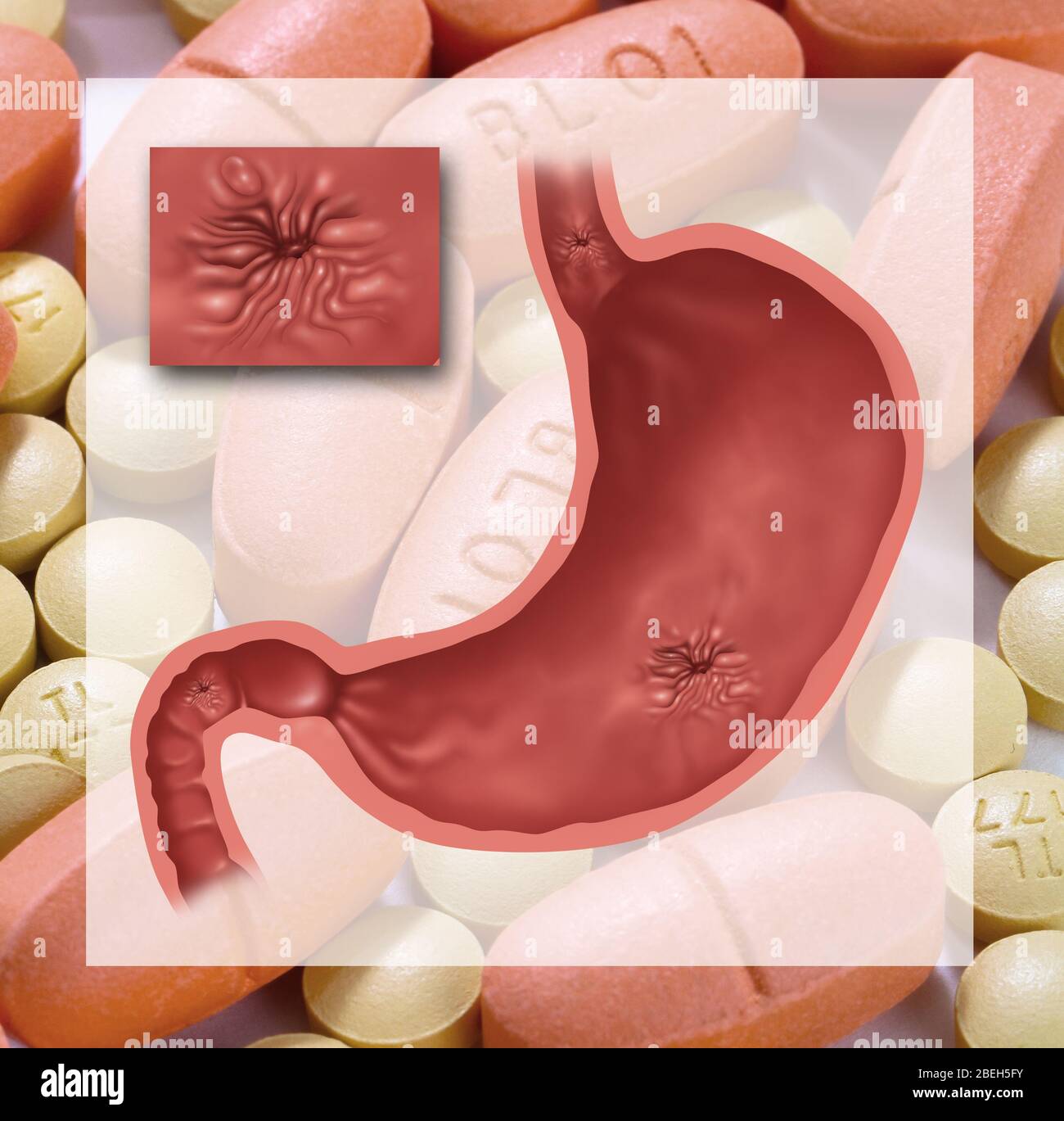 Ulcer pills hi-res stock photography and images - Alamy