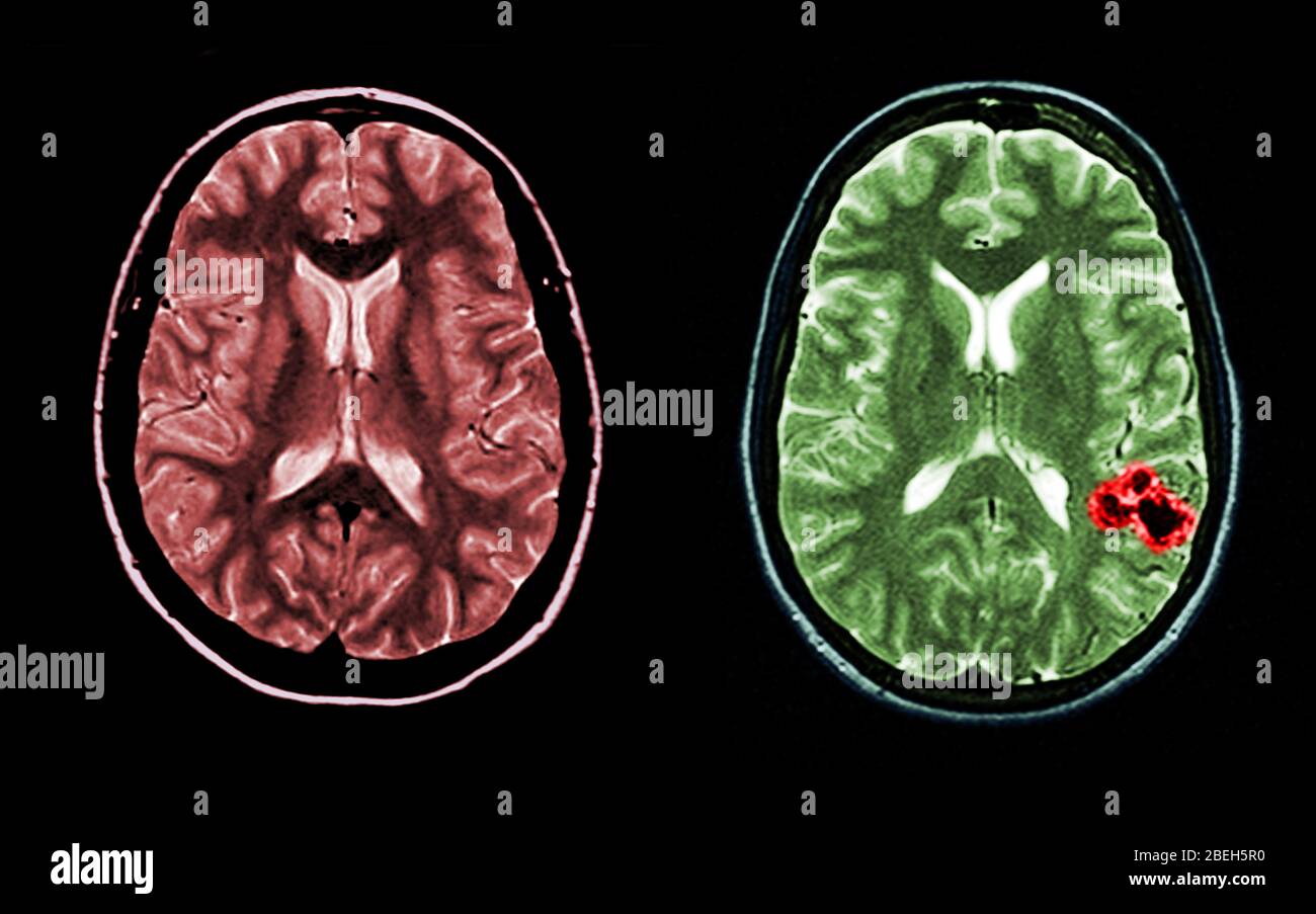 Avm brains hi-res stock photography and images - Alamy