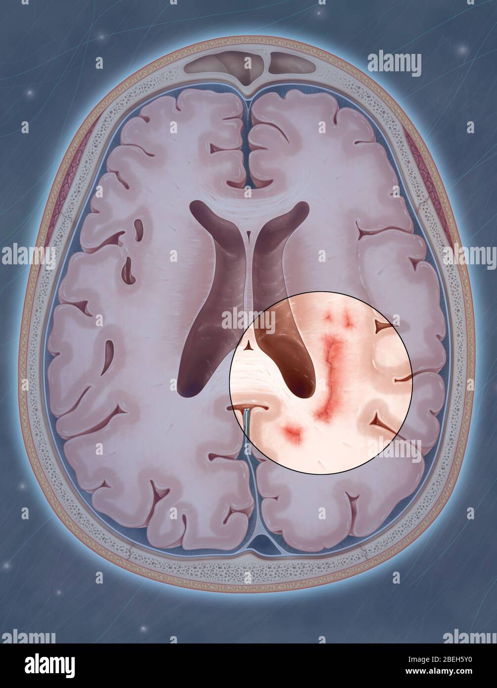 Multiple sclerosis brain hi-res stock photography and images - Alamy