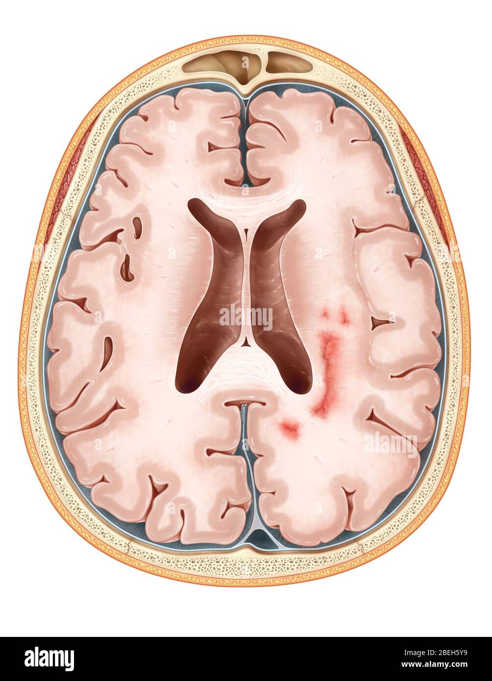 Multiple sclerosis brain hi-res stock photography and images - Alamy