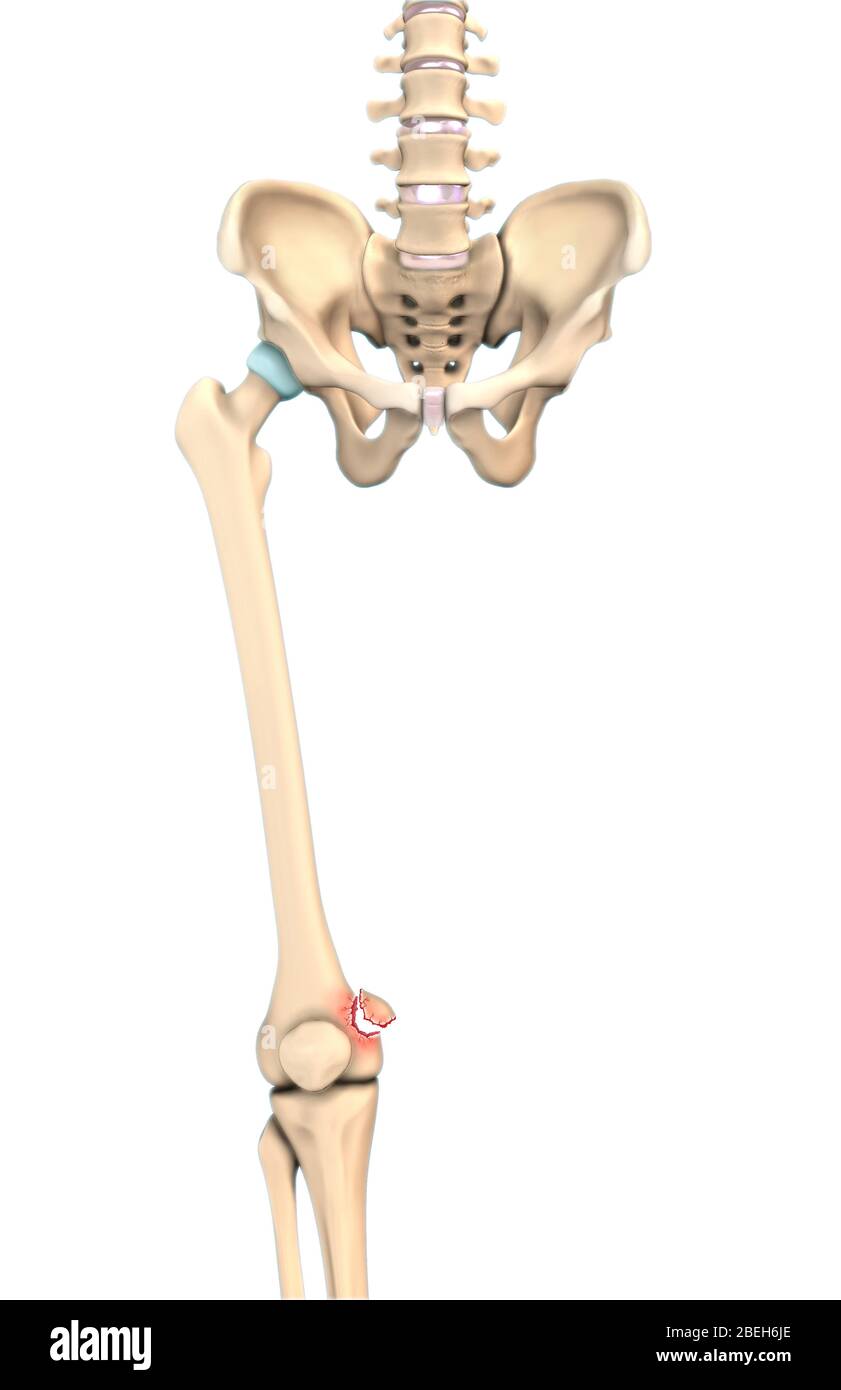 Avulsion Bone Fracture, Illustration Stock Photo - Alamy
