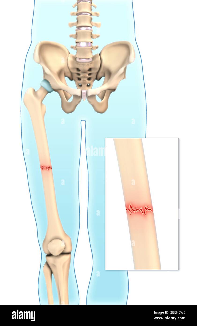 Transverse fracture hi-res stock photography and images - Alamy