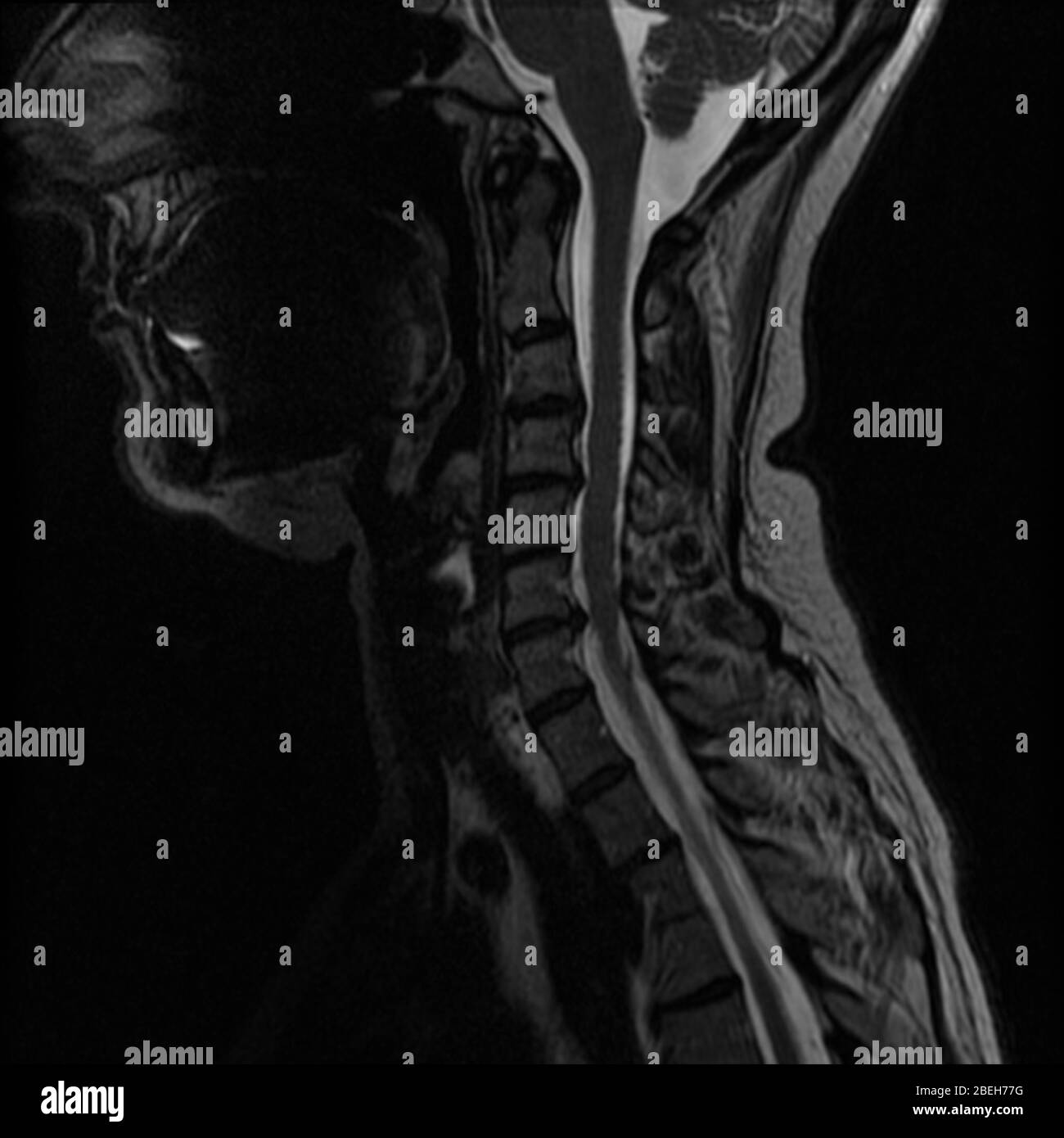 Bulging disc hi-res stock photography and images - Alamy