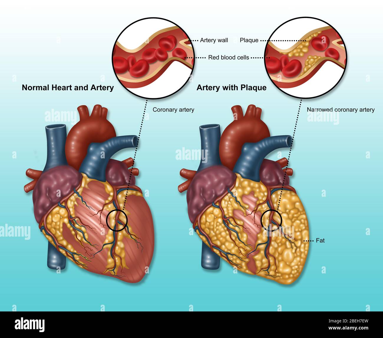 Heart and Artery, Normal vs. Hardened Stock Photo - Alamy