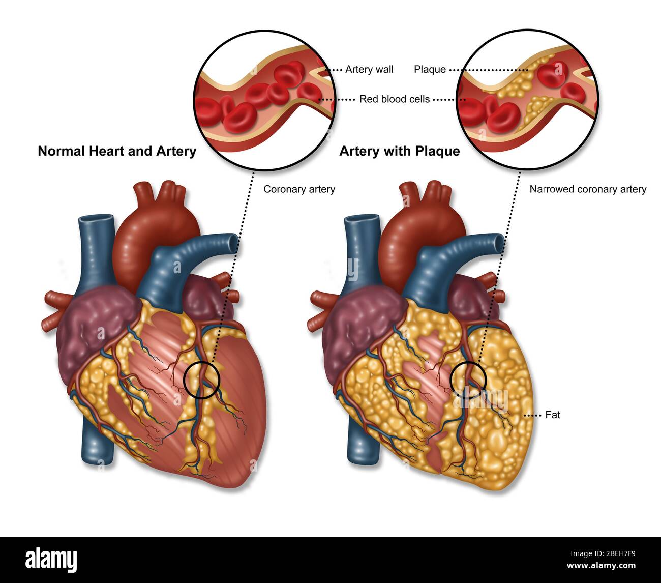 Heart and Artery, Normal vs. Hardened Stock Photo - Alamy