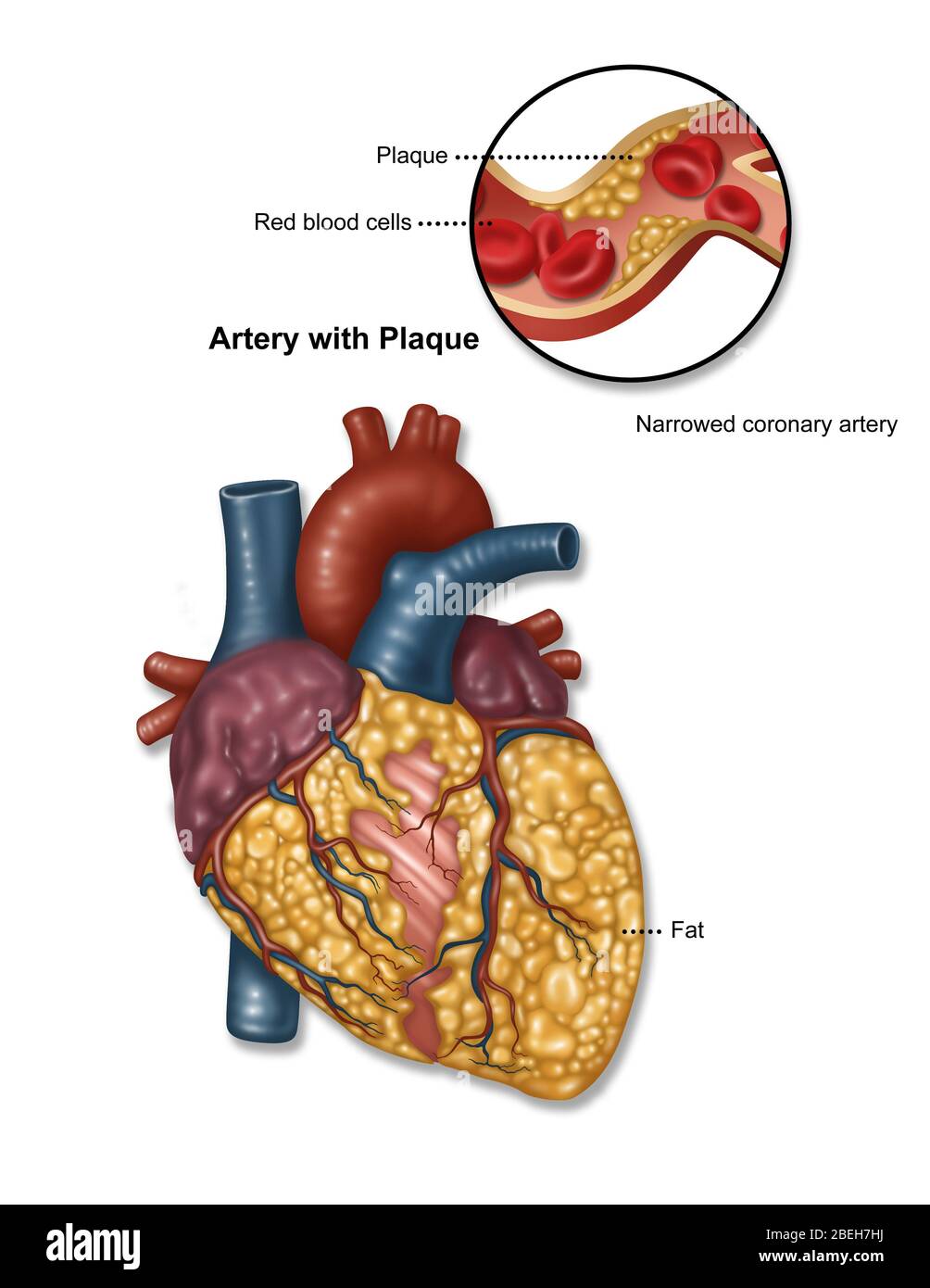 Heart Artery with Plaque, Illustration Stock Photo - Alamy
