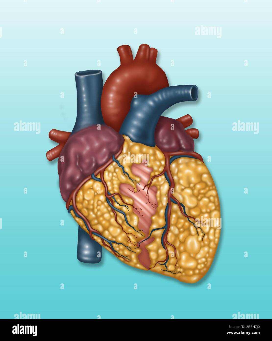 Unhealthy Heart Diagram