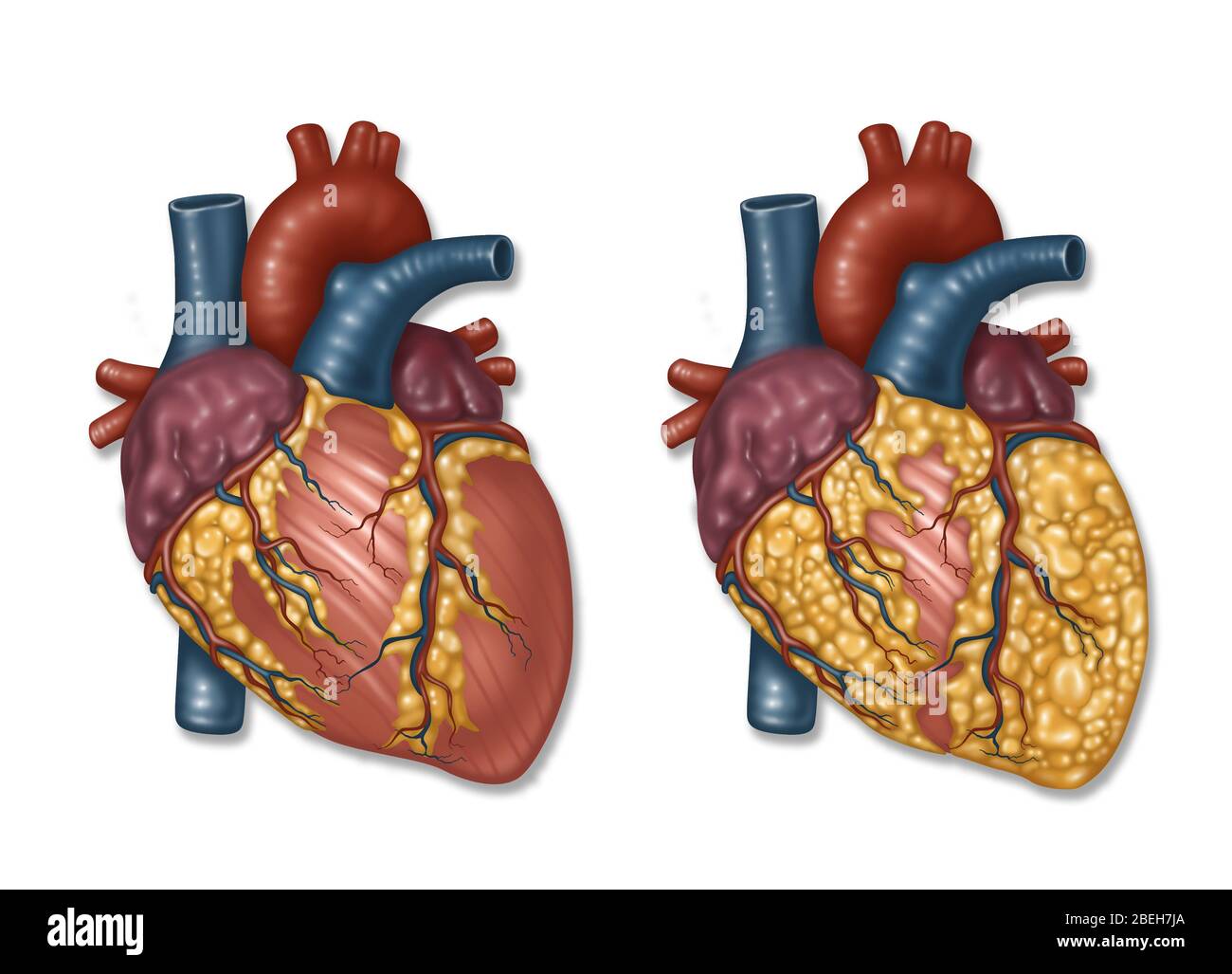 Comparison of a normal heart artery and an artery with plaque, a cause ...