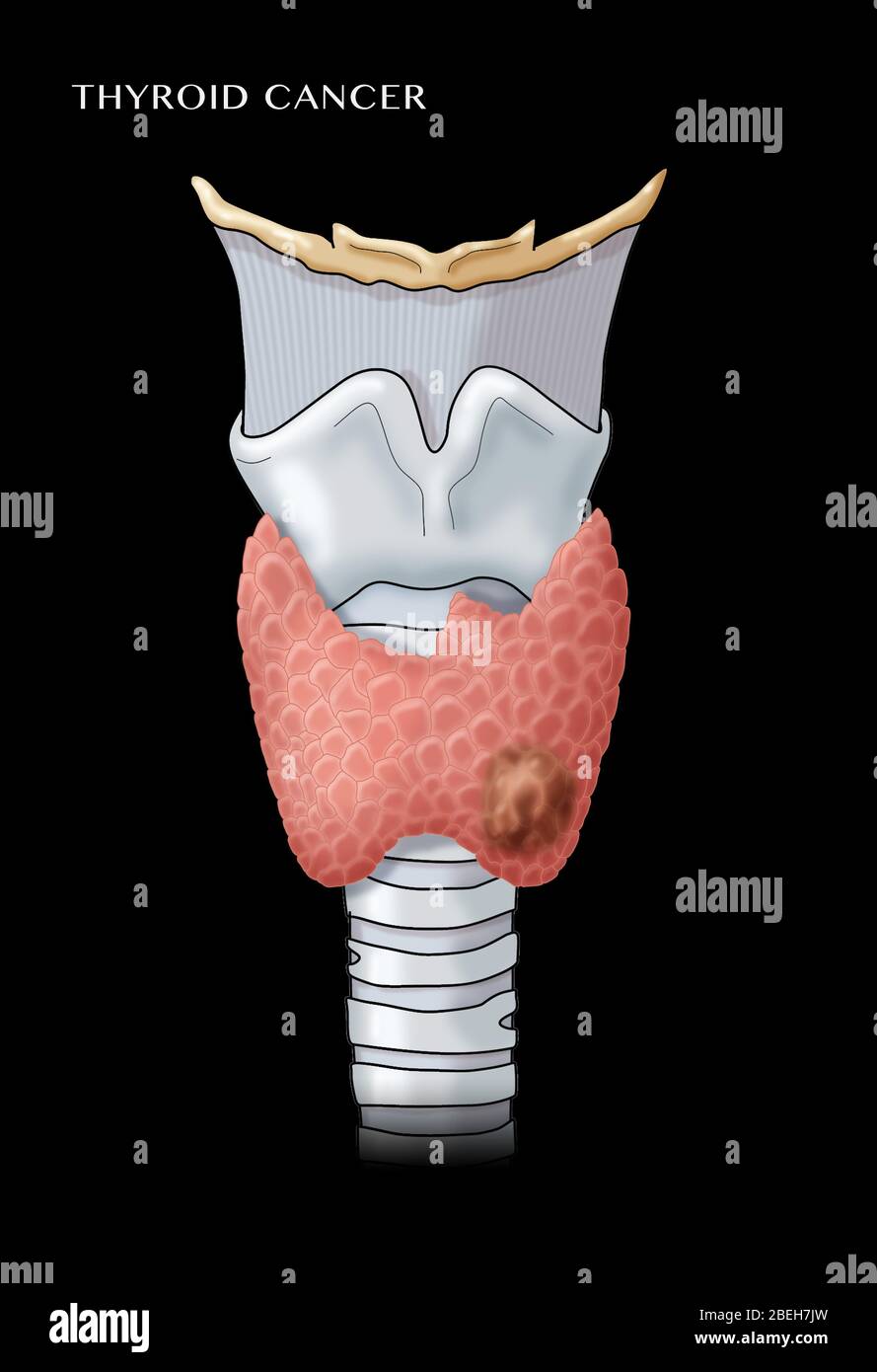 Larynx cancer hi-res stock photography and images - Alamy