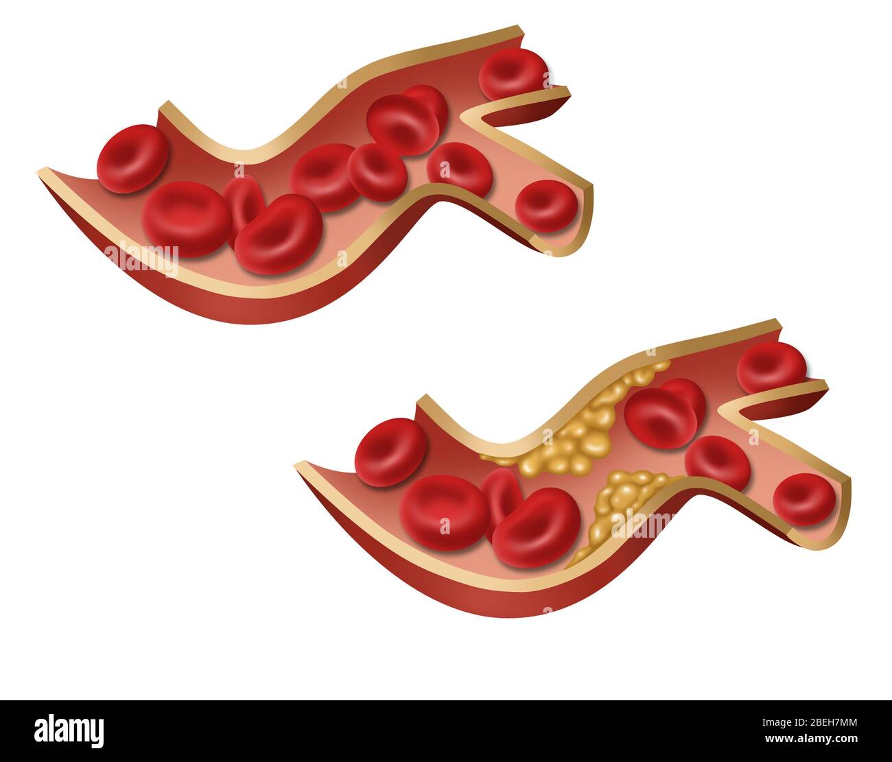 Normal and clogged artery hi-res stock photography and images - Alamy