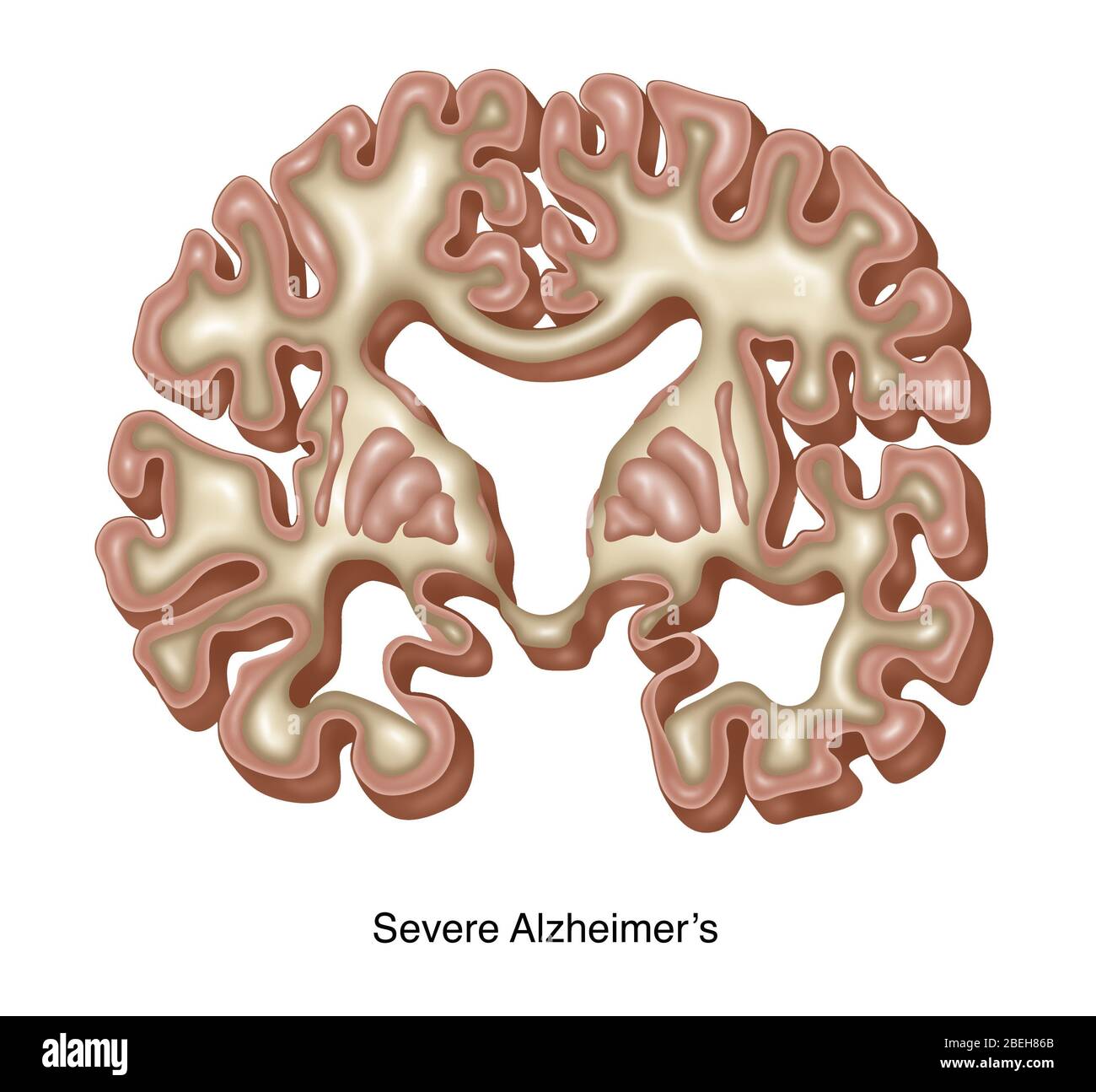 Severe disease Cut Out Stock Images & Pictures - Alamy