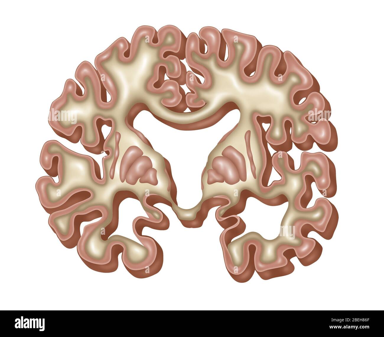 Severe Alzheimer's, Illustration Stock Photo - Alamy