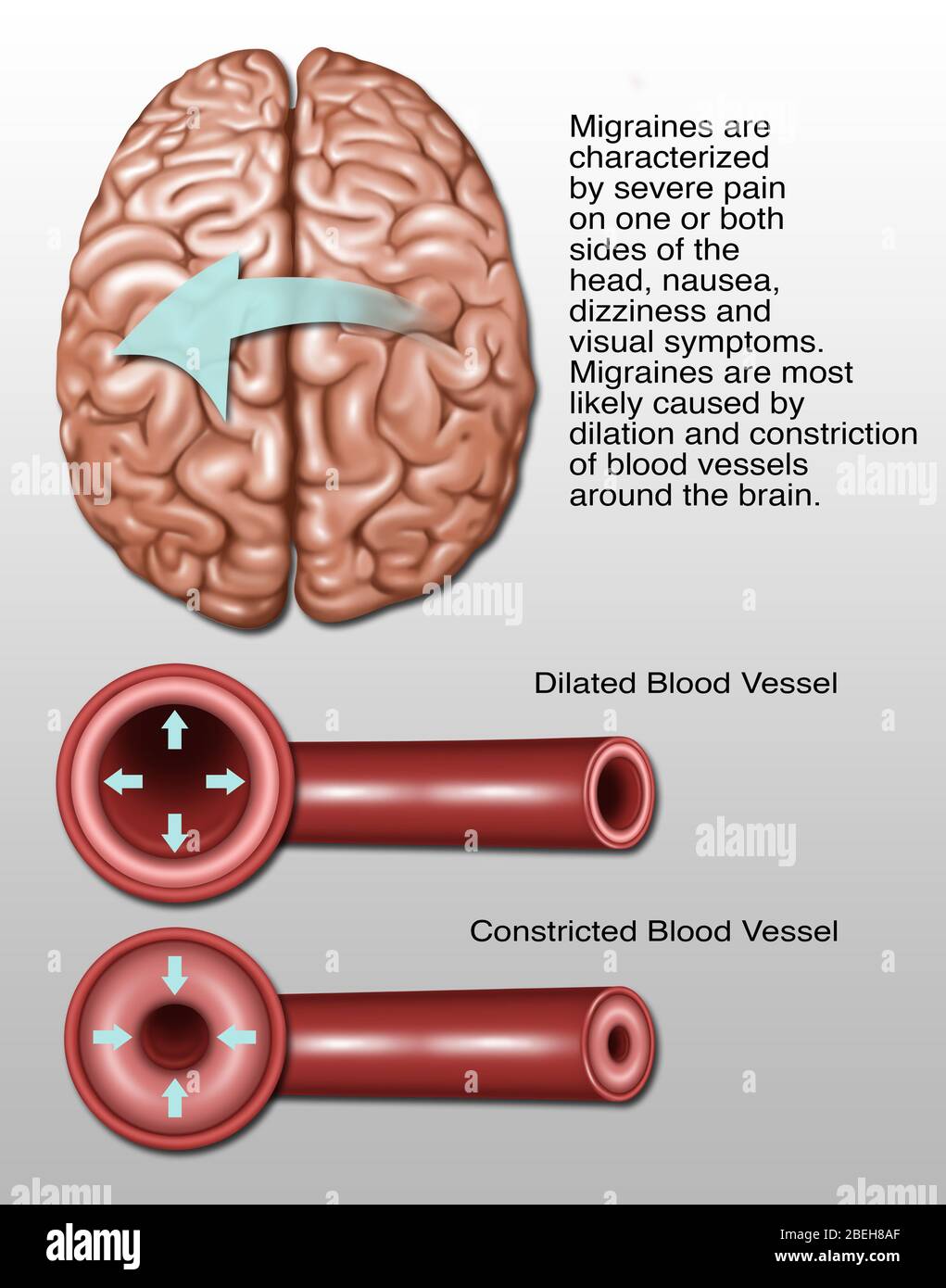 Constricted blood vessel hi-res stock photography and images - Alamy