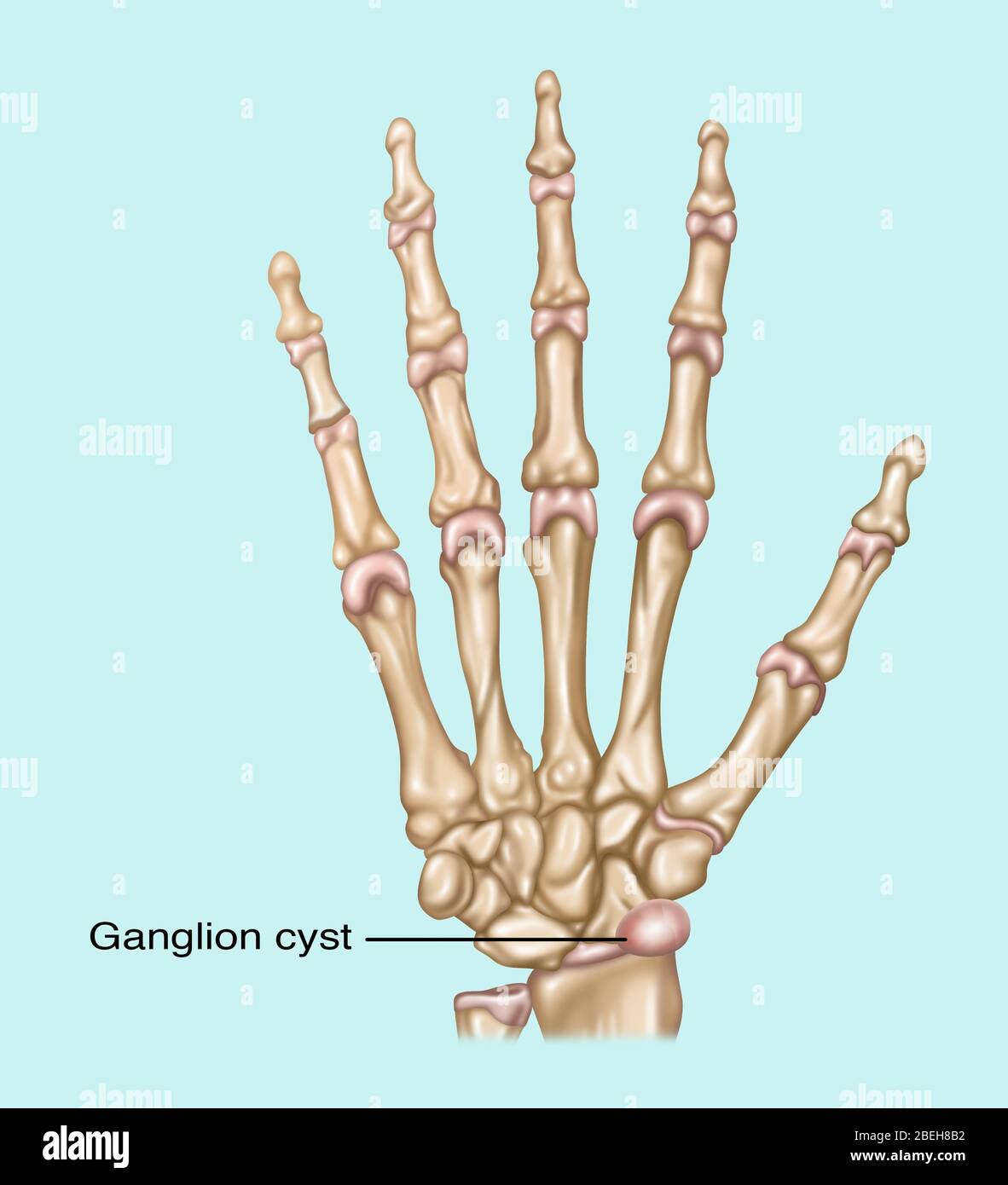 Ganglion cyst hi-res stock photography and images - Alamy