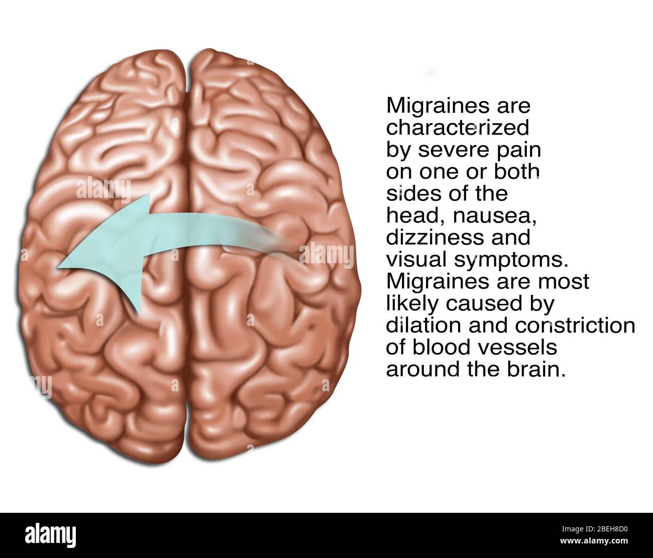 Migraine Brain