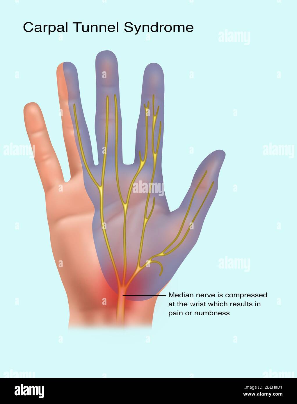 Carpal Tunnel Syndrome, Illustration Stock Photo - Alamy