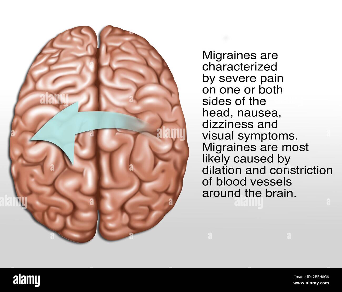 Migraine illustration hi-res stock photography and images - Alamy