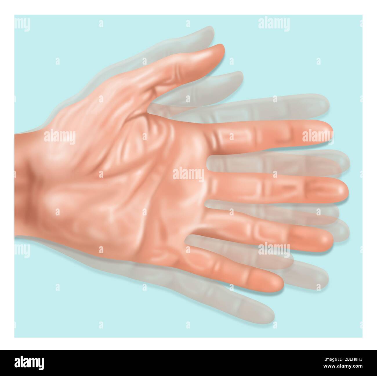 Illustration of hand tremors, a symptom of Parkinson's disease ...