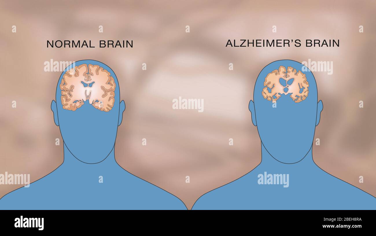Alzheimer's brain comparison hi-res stock photography and images - Alamy