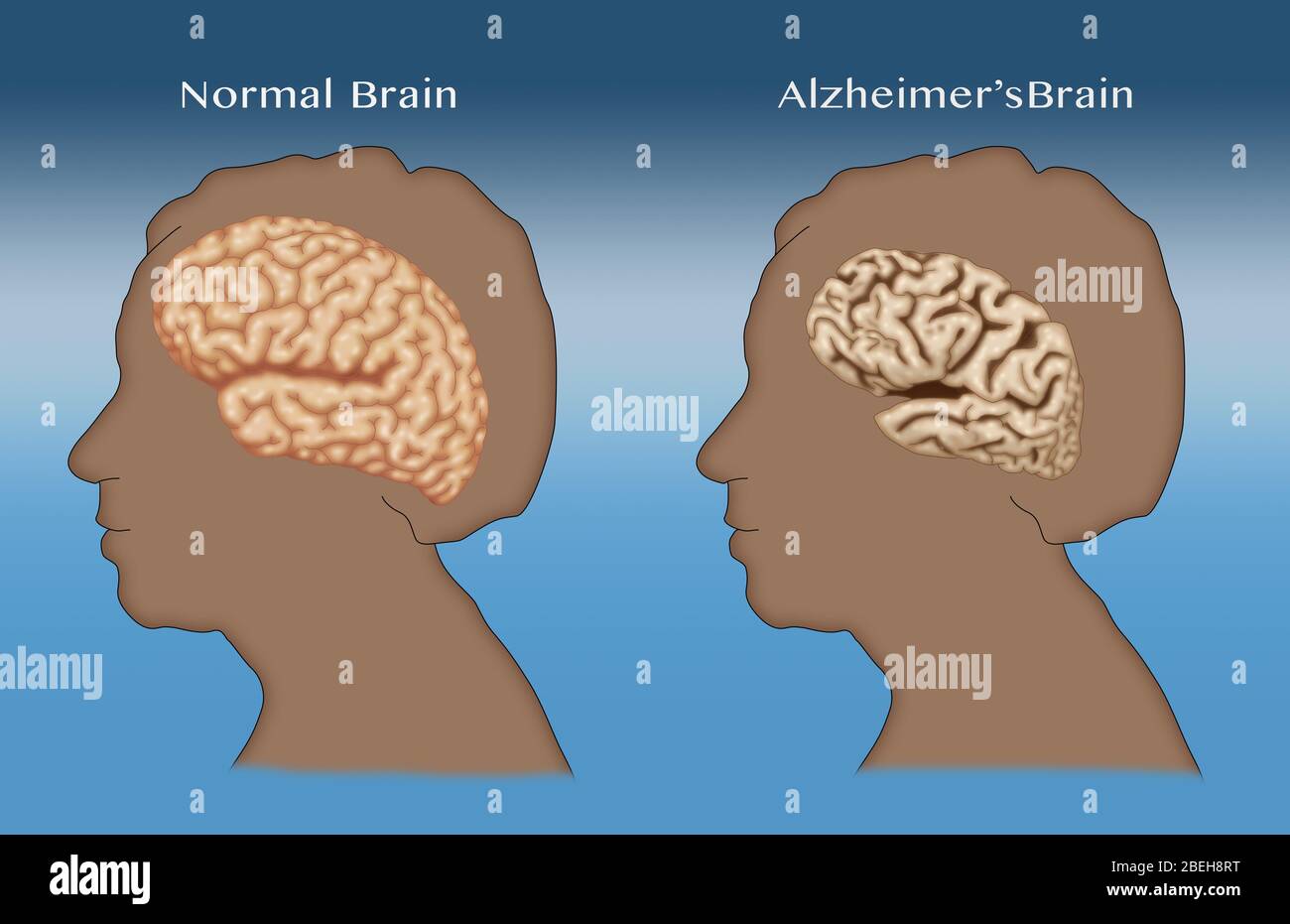 Alzheimer brain comparison hi-res stock photography and images - Alamy