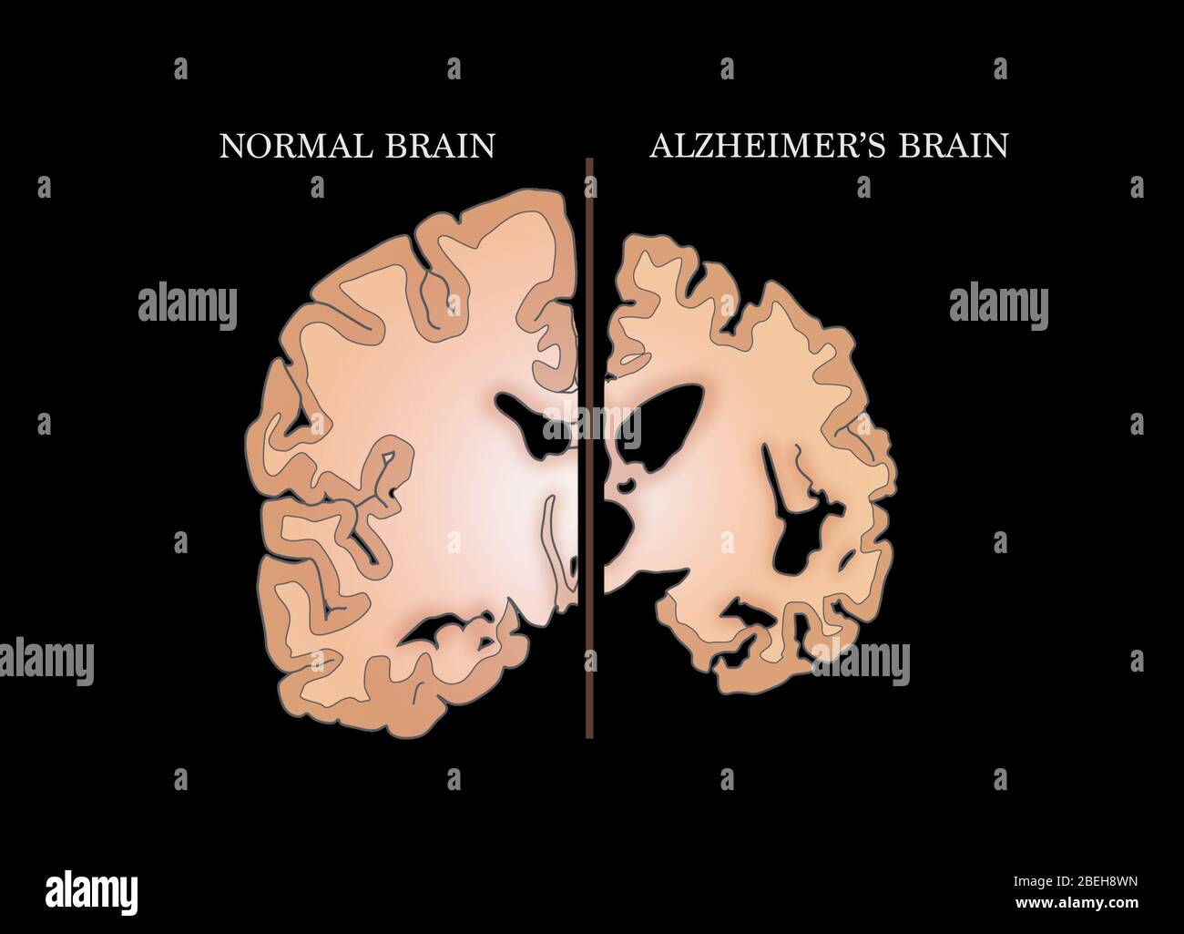 Alzheimer's and Normal Brains, Comparison Stock Photo - Alamy