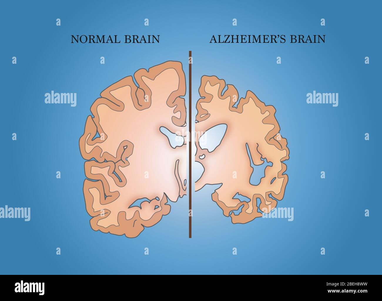 Brain alzheimer comparison hi-res stock photography and images - Alamy