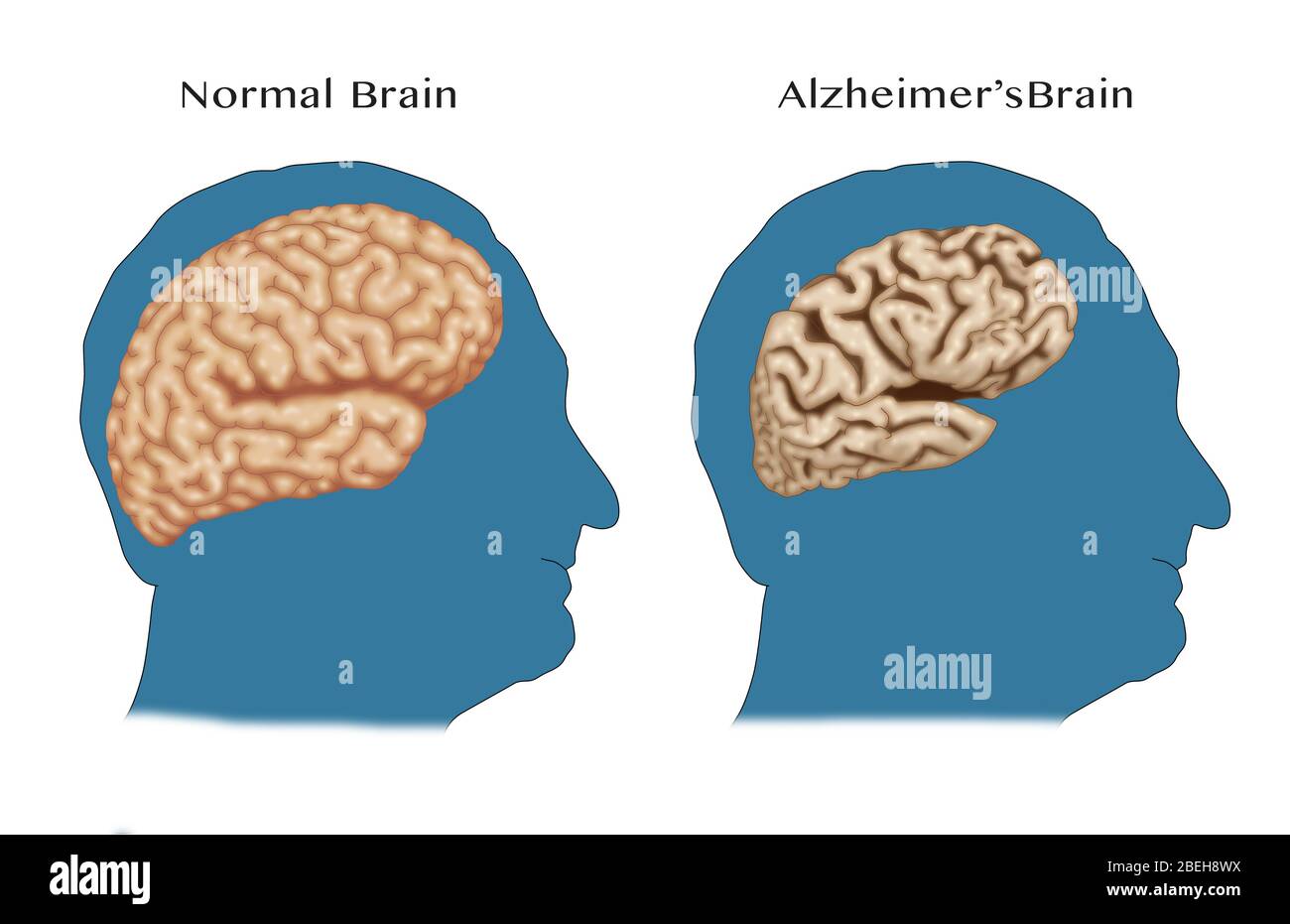 Alzheimer's and Normal Brains, Comparison Stock Photo - Alamy