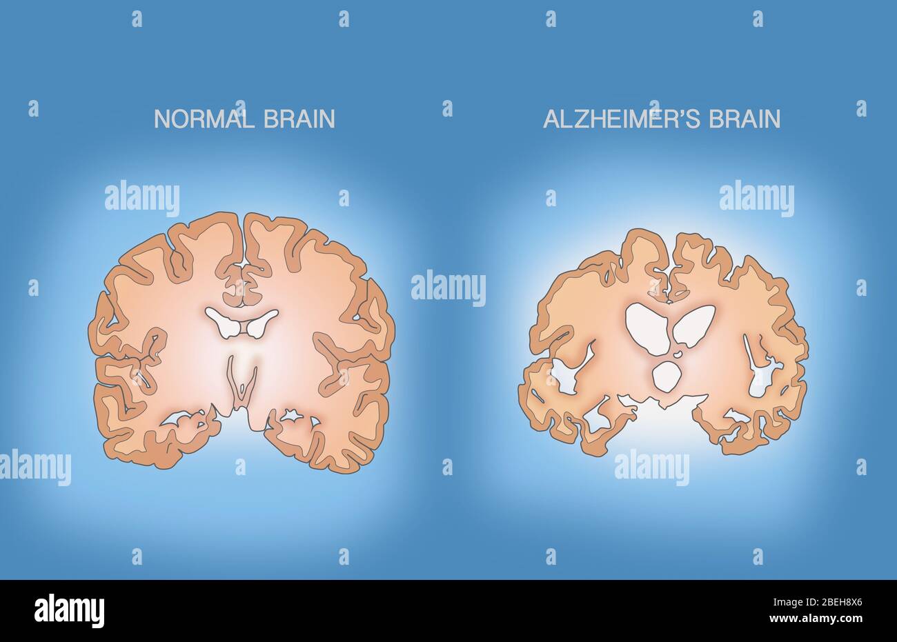 Alzheimer's and Normal Brains, Comparison Stock Photo - Alamy