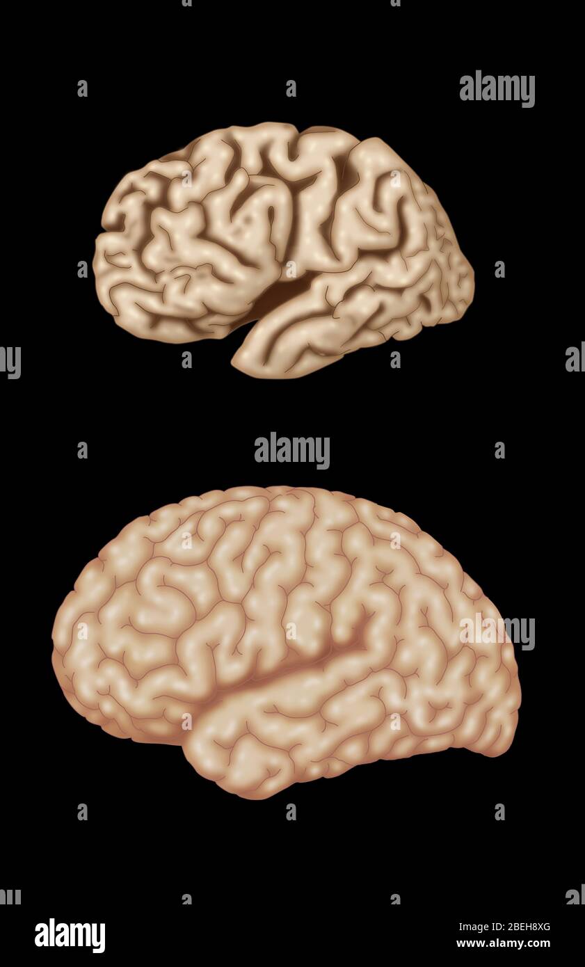 Alzheimer's and Normal Brains, Comparison Stock Photo - Alamy