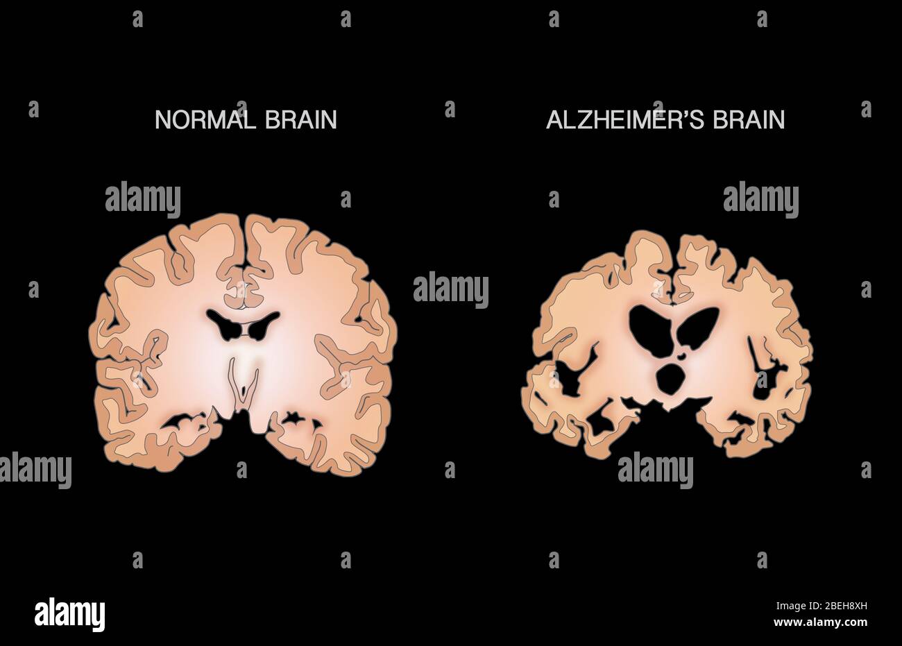 Alzheimer's and Normal Brains, Comparison Stock Photo - Alamy