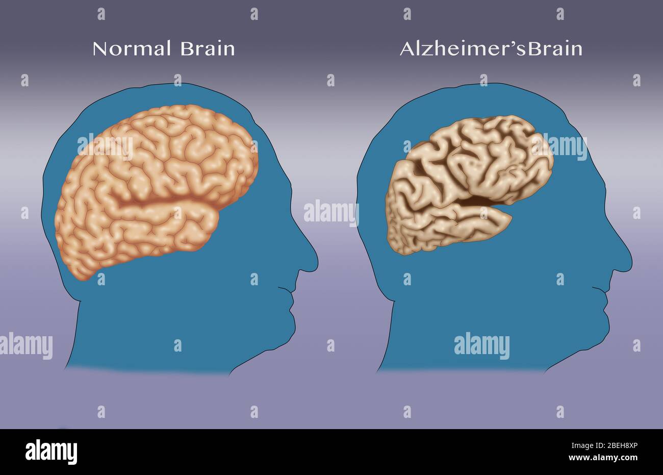 Alzheimer's and Normal Brains, Comparison Stock Photo - Alamy