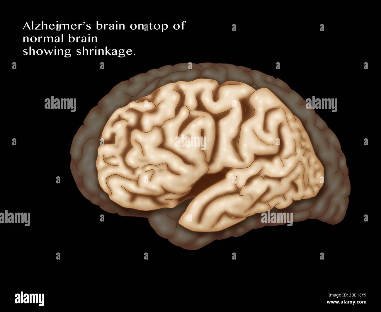 Alzheimer's and Normal Brain, Comparison Stock Photo - Alamy