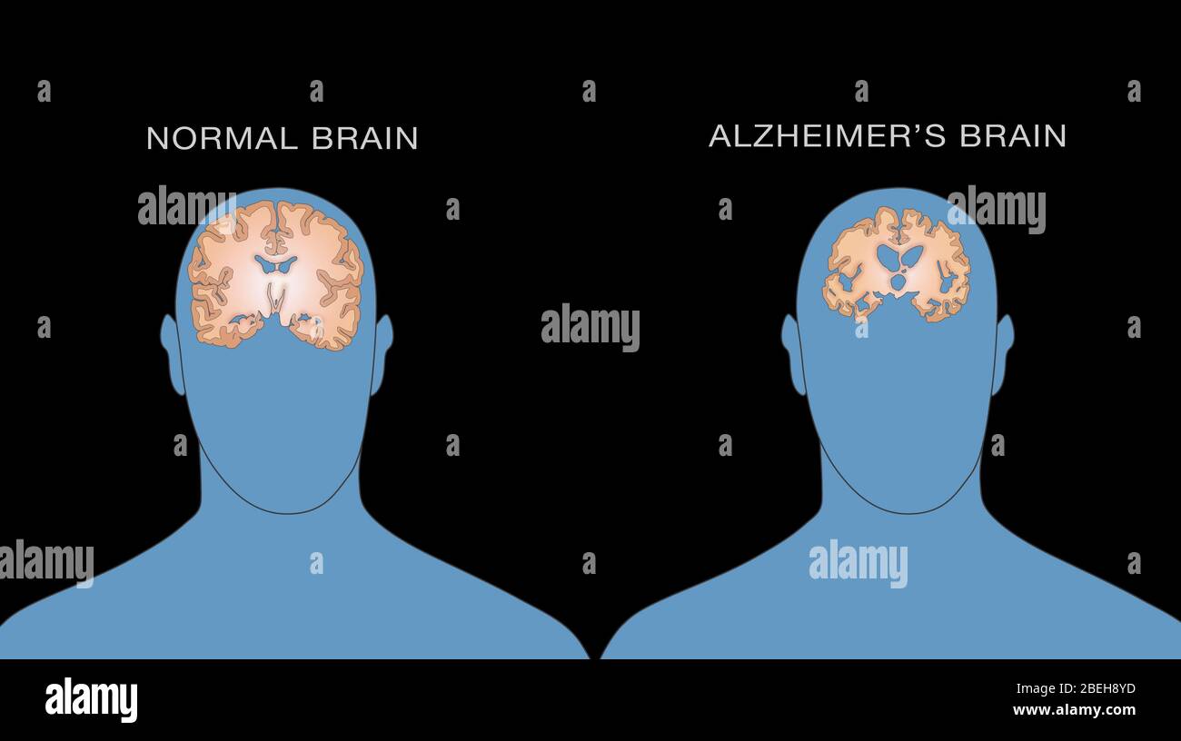 Alzheimer's and Normal Brains, Comparison Stock Photo - Alamy