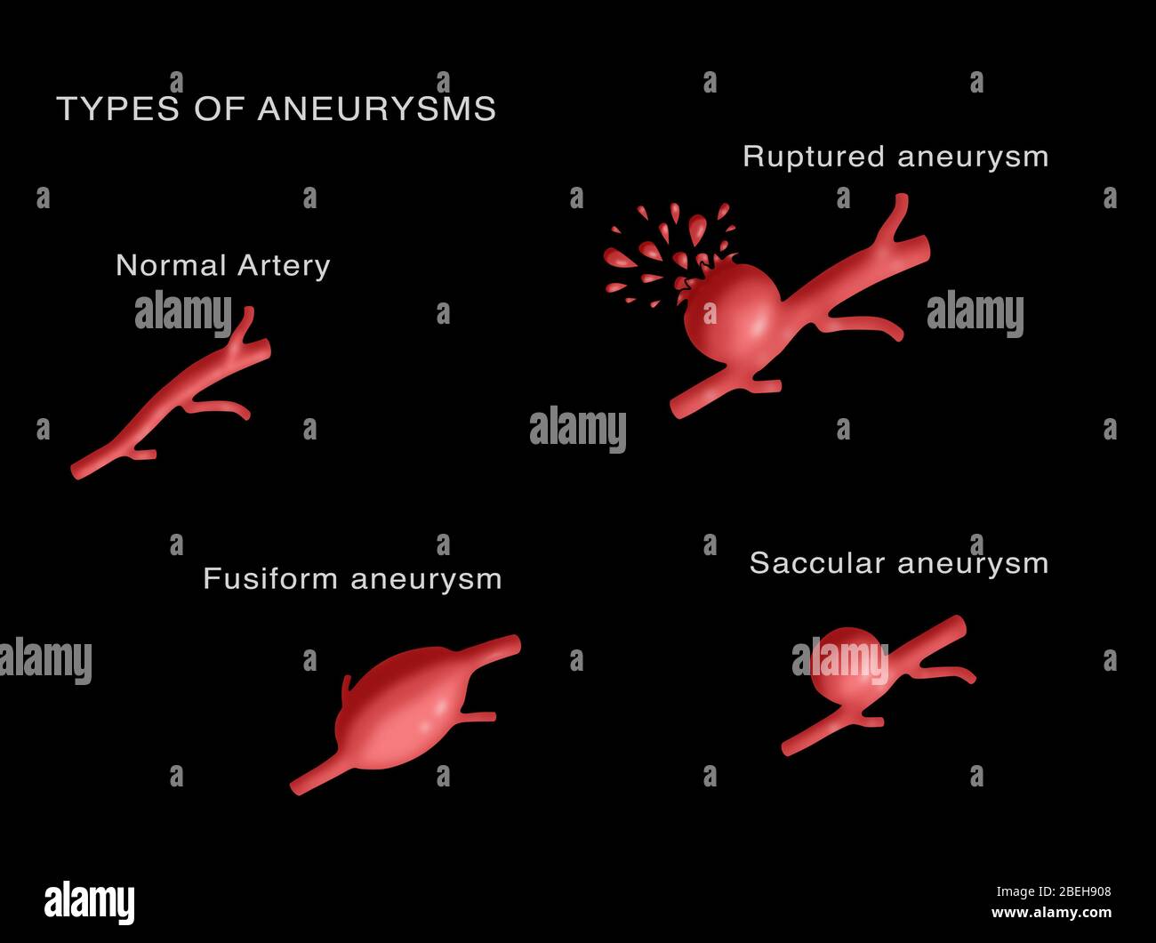 Hemorrhage types hi-res stock photography and images - Alamy