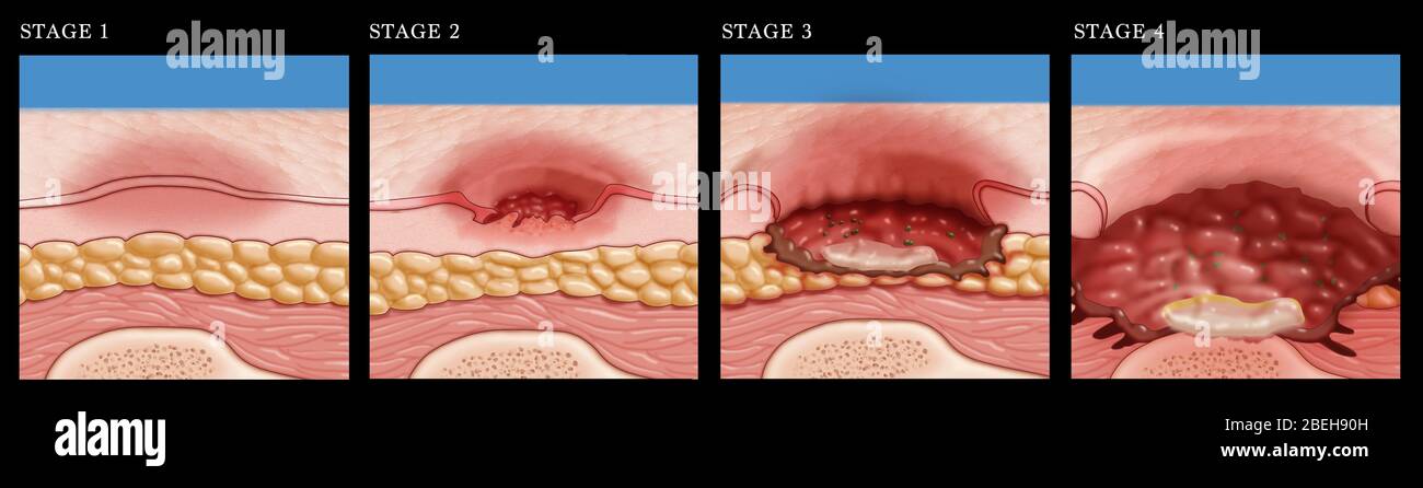 Pressure sore stage hi-res stock photography and images - Alamy