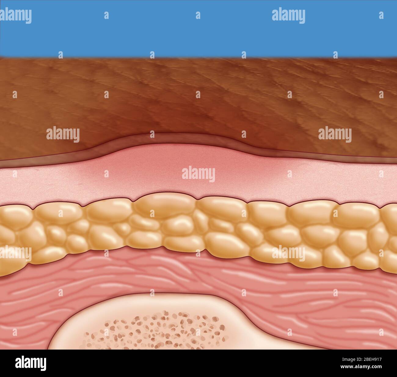 Pressure Sore, Stage 1 Stock Photo - Alamy
