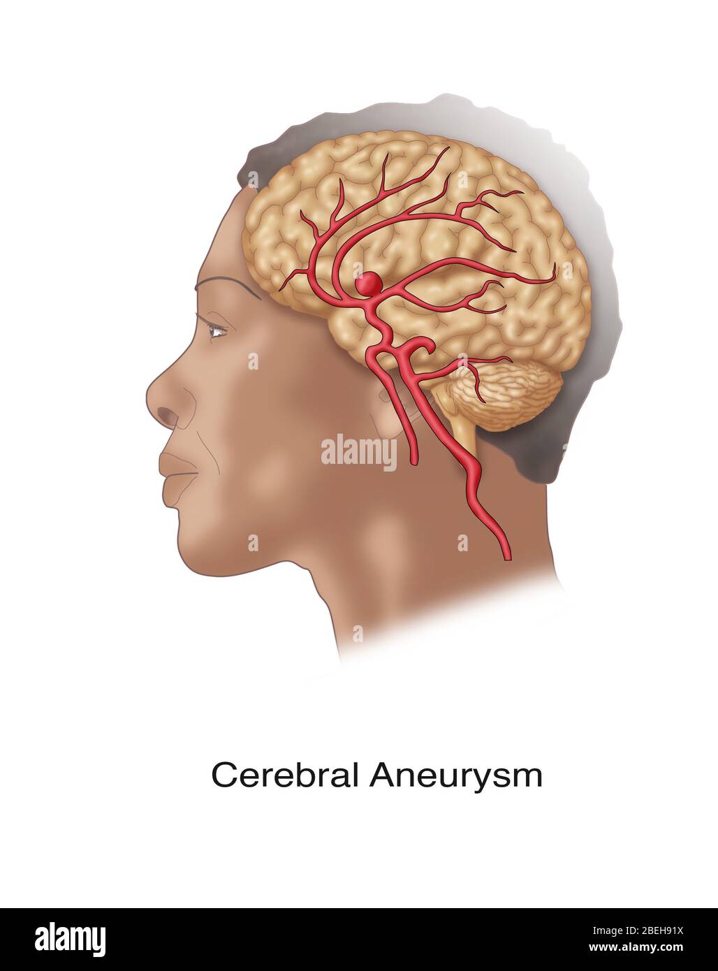 Brain hemorrhage anatomy hi-res stock photography and images - Alamy