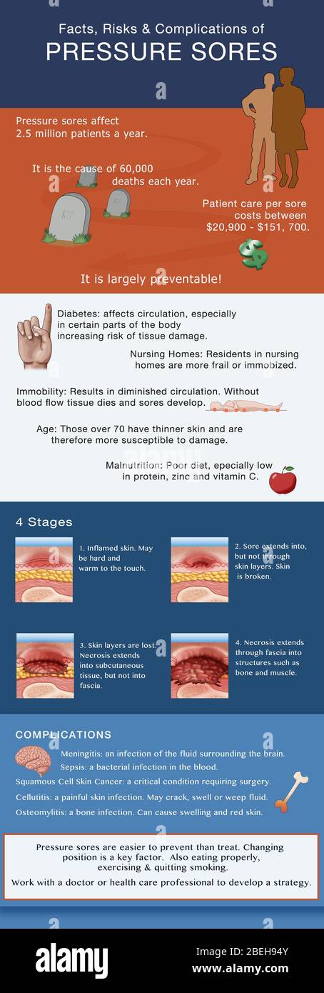 Pressure Sore infographic Stock Photo - Alamy