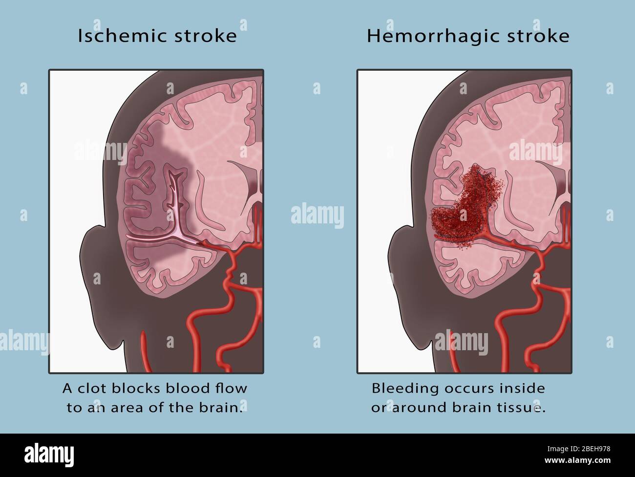 Hemorrhagic Stroke High Resolution Stock Photography and Images - Alamy