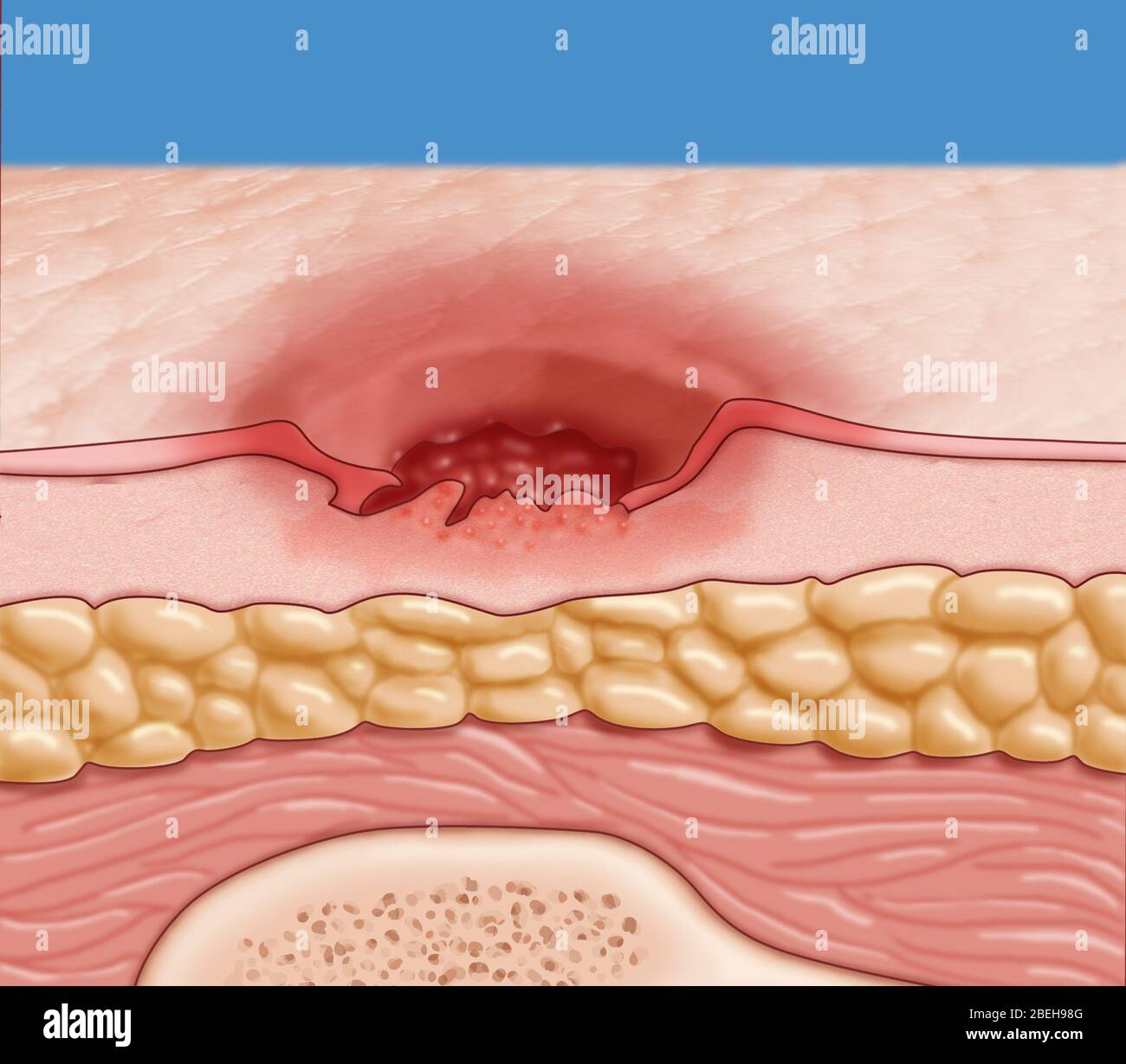 Stage 2 sore hi-res stock photography and images - Alamy