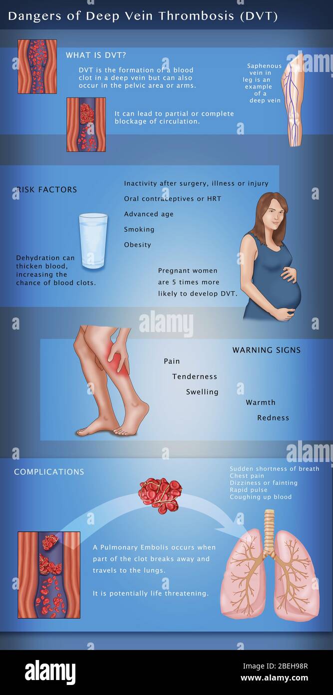 Deep Vein Thrombosis Infographic Stock Photo - Alamy
