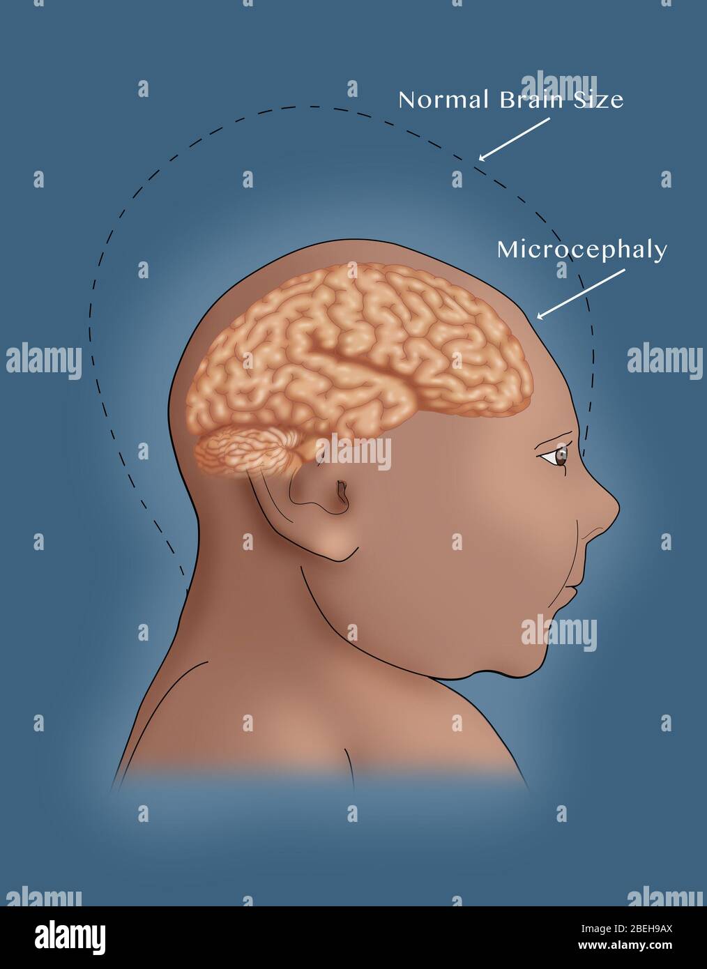 Microcephaly brain hi-res stock photography and images - Alamy