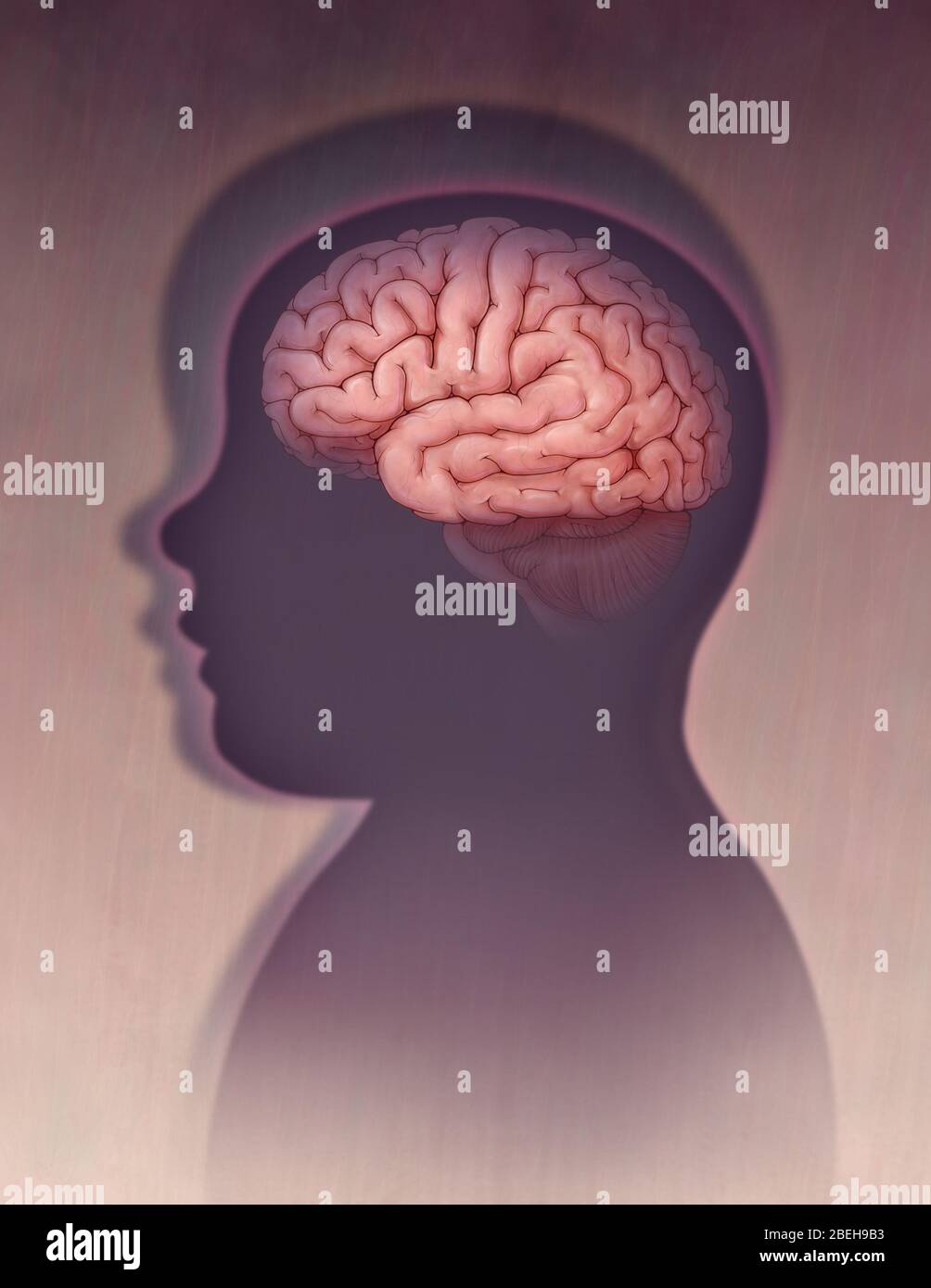 Microcephaly High Resolution Stock Photography and Images - Alamy